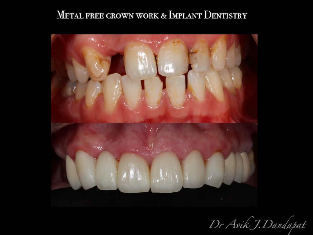 Dental Implant Cases - Dental Implant Centre Twyford